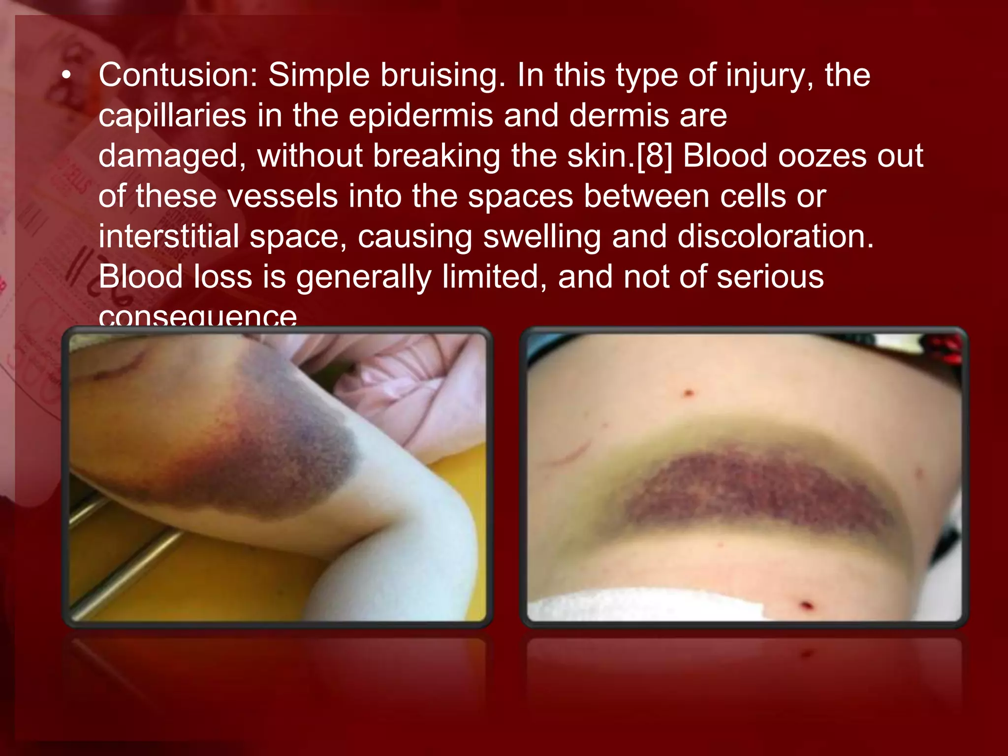 Bleeding management | PPTX