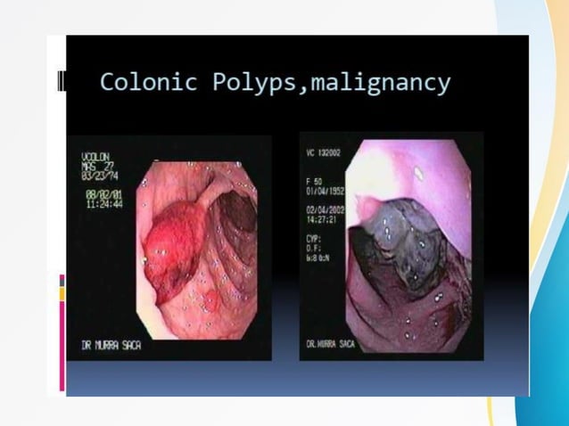 Bleeding per rectum | PDF