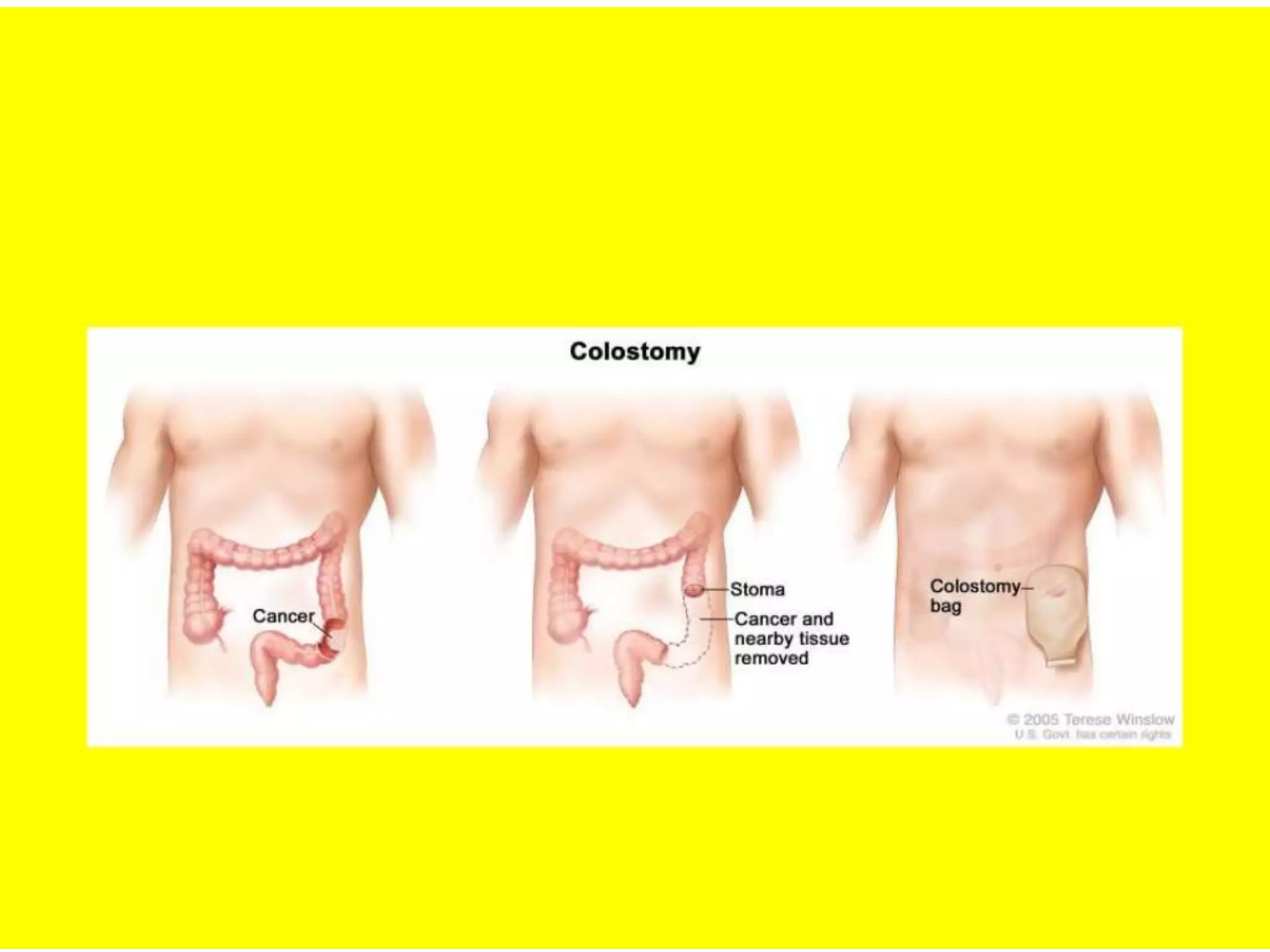 BLEEDING PER RECTUM BASIC MEDICAL KNOWLEDGE & MANAGEMENT.ppt