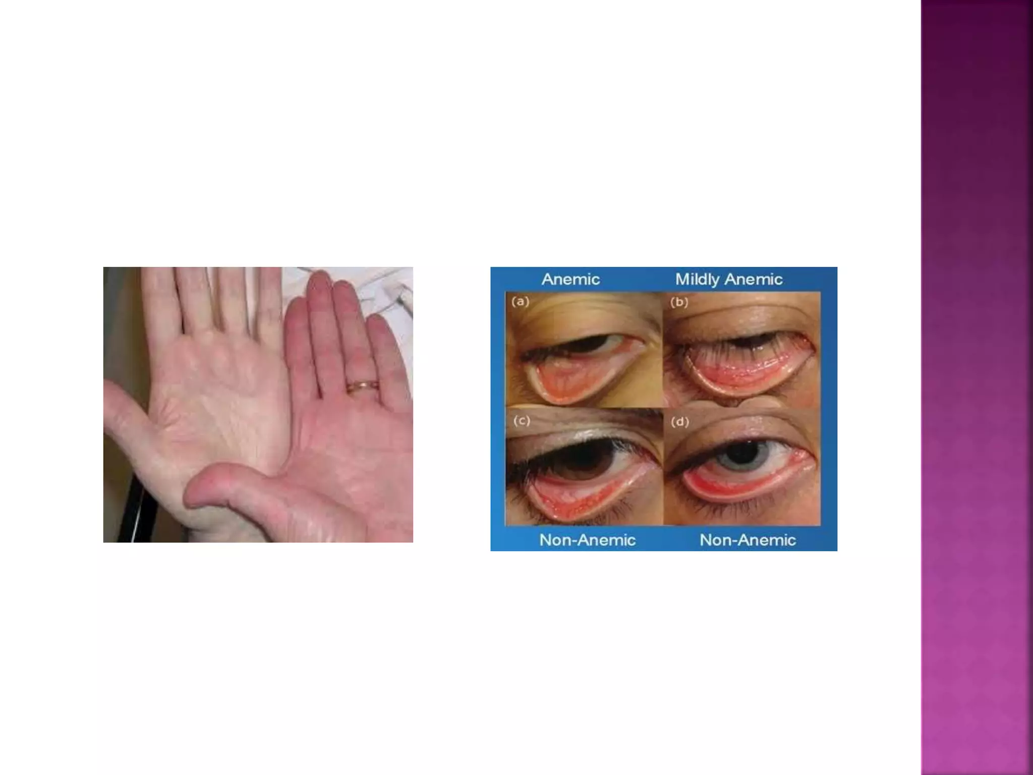 Bleeding pv BY DR TOUSIF SHEIKH | PPTX