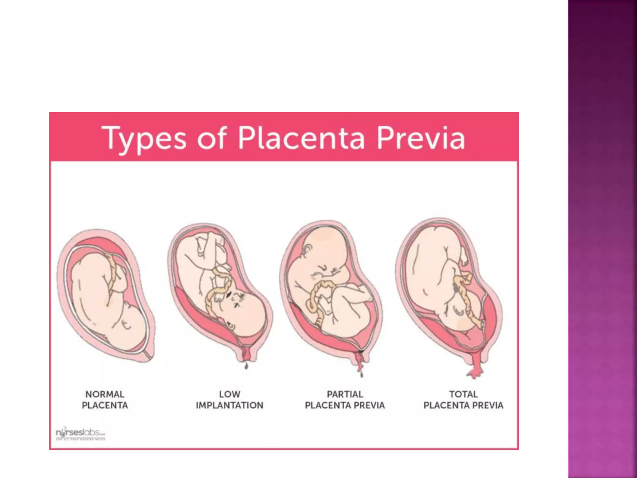 Bleeding pv BY DR TOUSIF SHEIKH | PPTX
