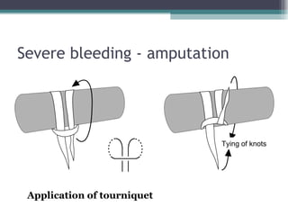Bleeding shock | PPT