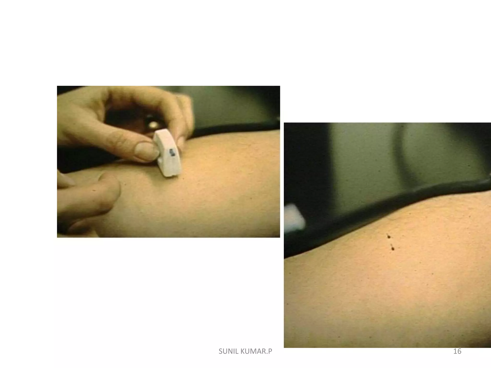 Bleeding time and clotting time | PPTX