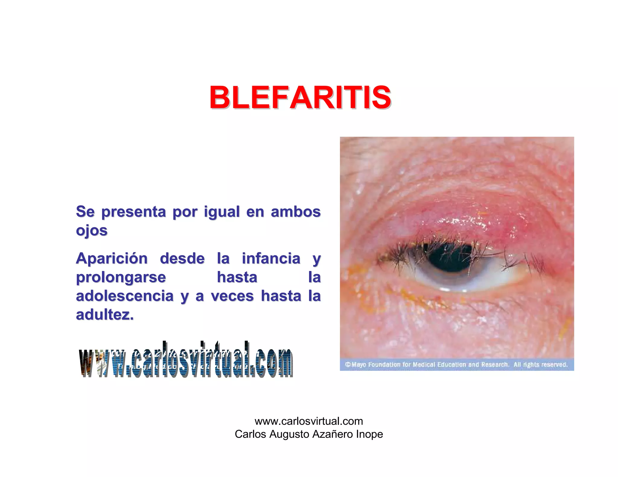 Blefaritis | PDF