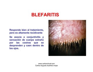 Blefaritis | PDF