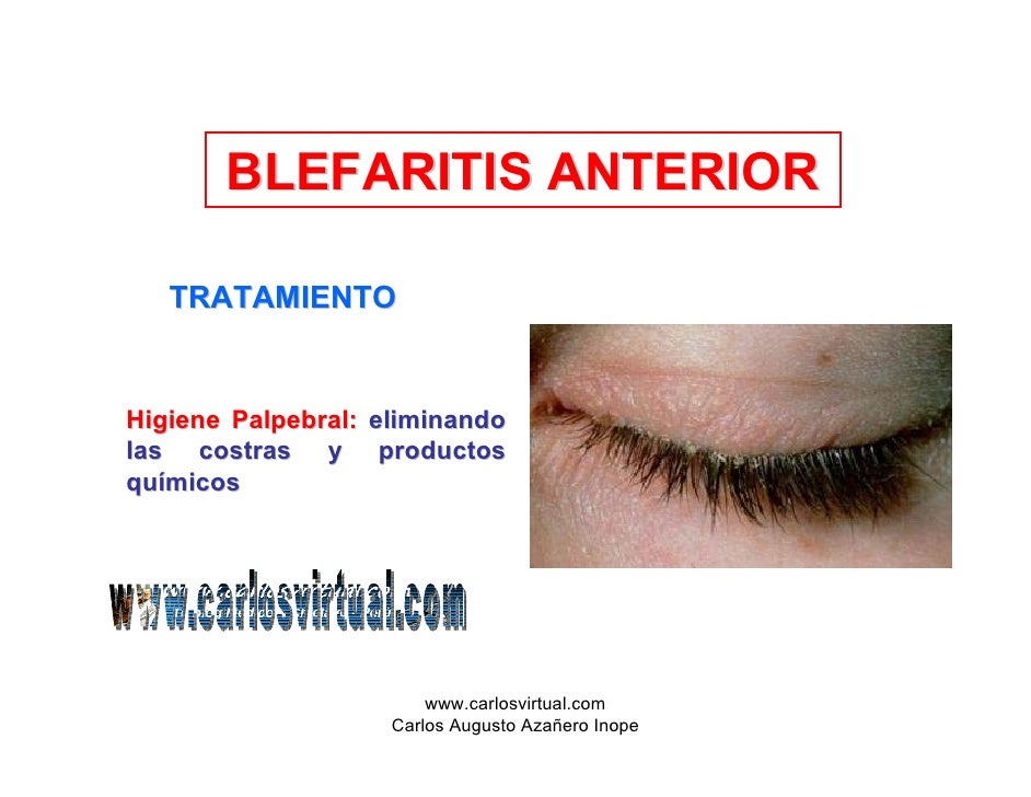Blefaritis Causas Y Tratamiento – PSFLM
