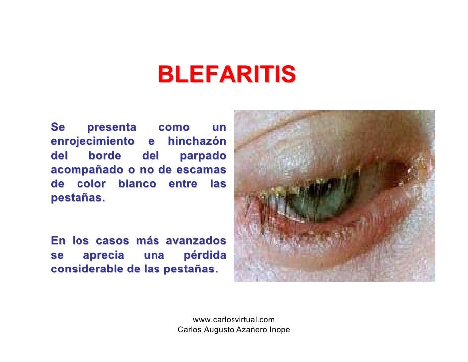 Blefaritis