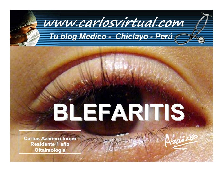 Blefaritis