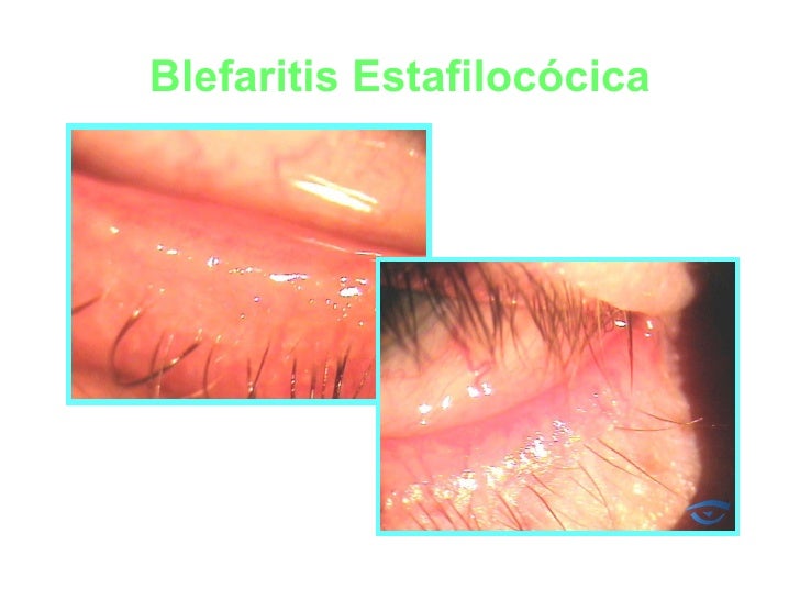 Blefaritis