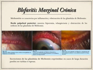 Blefaritis | PPT