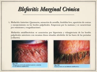 Blefaritis | PPT