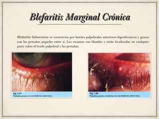 Blefaritis | PPT