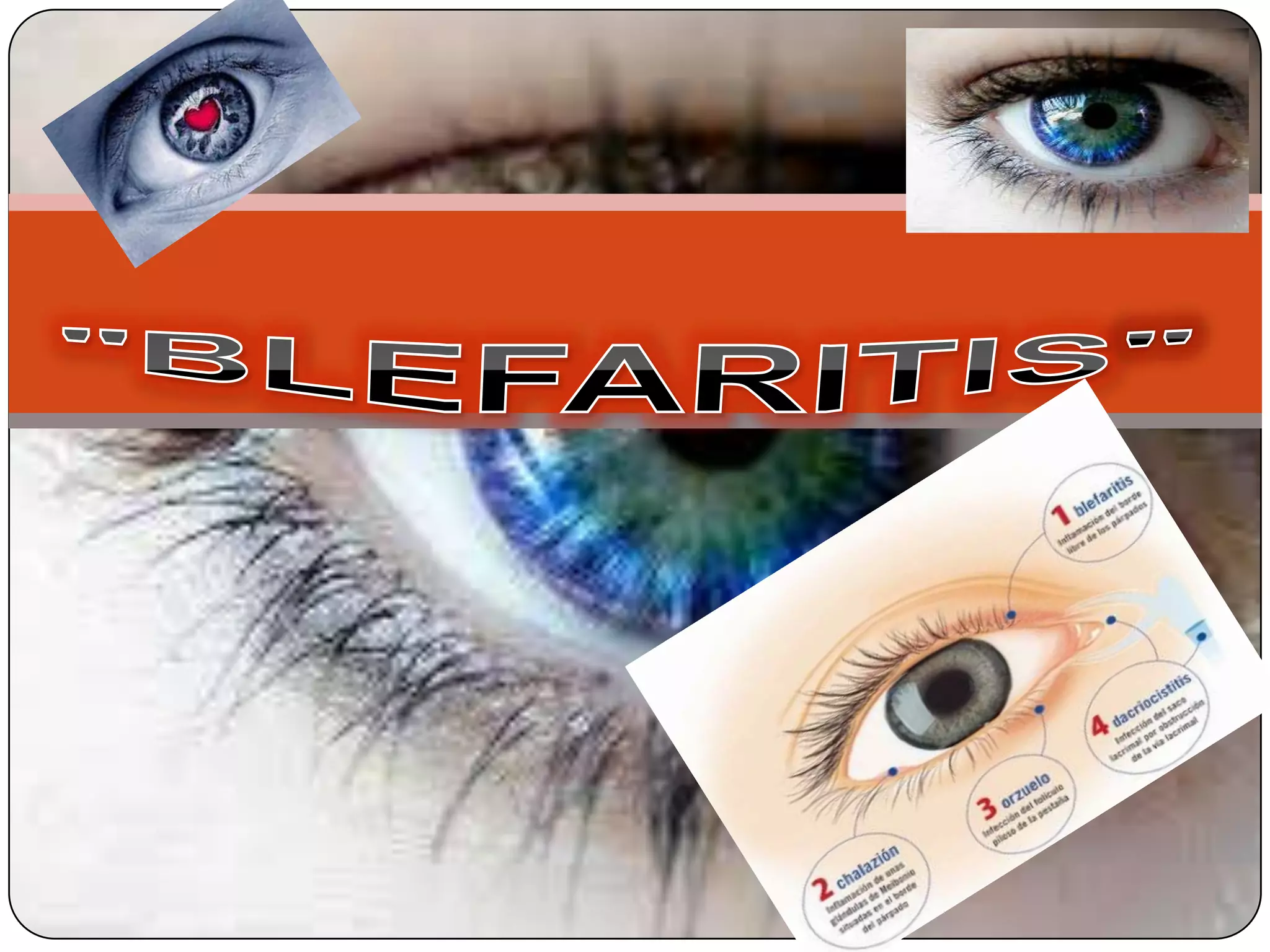Blefaritis | PPT