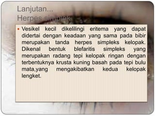 Blefaritis | PPTX