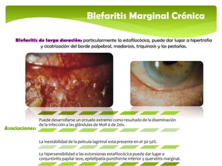 Blefaritis, Orzuelo y Chalazión | PPTX