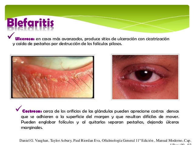Blefaritis, Orzuelo y Chalazión