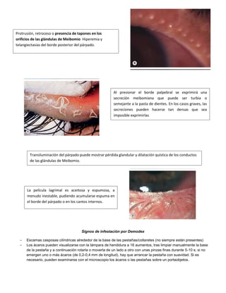 BLEFARITIS CRÓNICA marginal cronica.docx