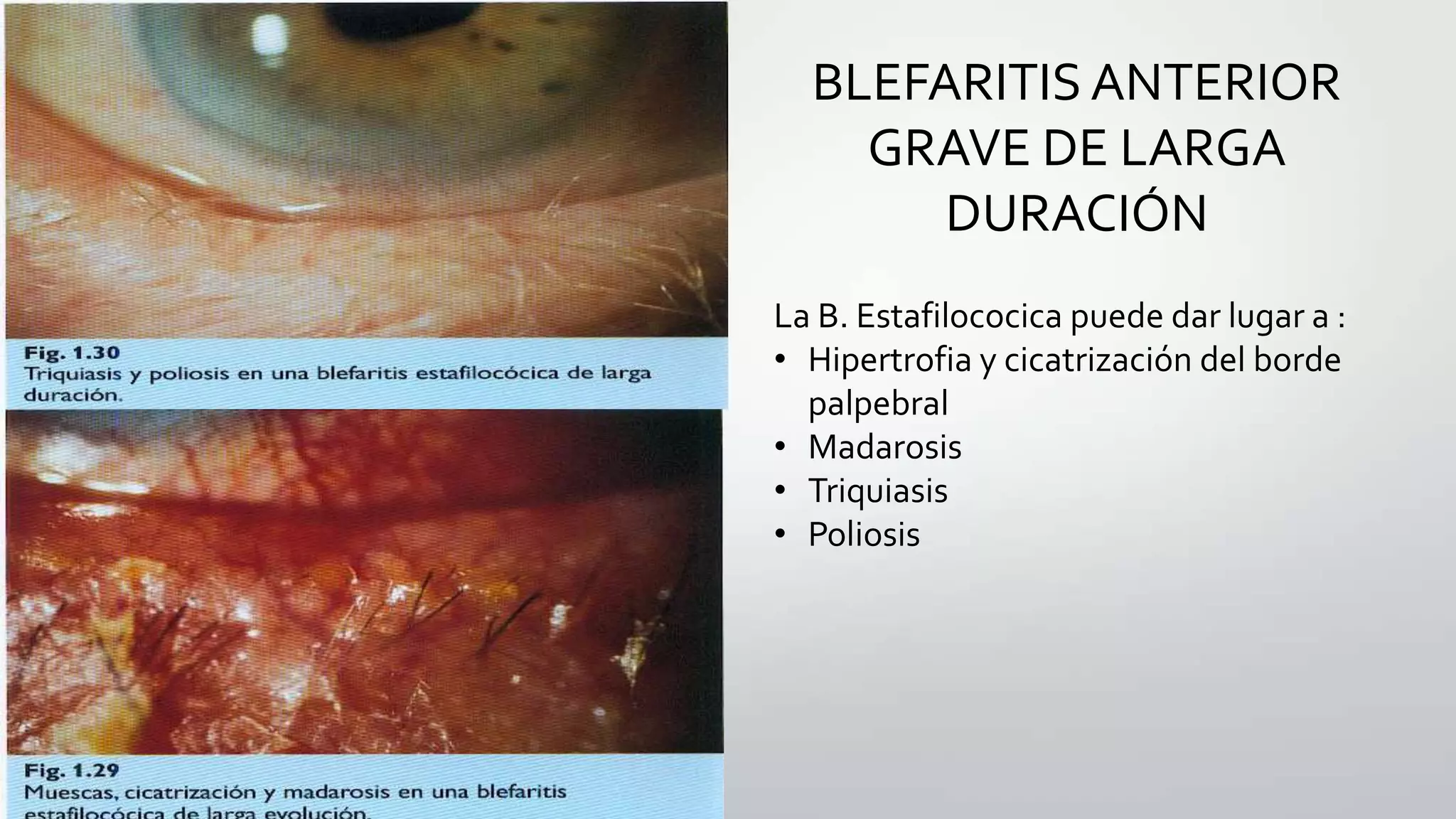 Blefaritis | PPT | Descarga gratuita