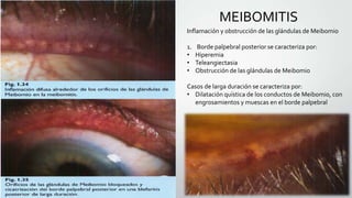 Blefaritis | PPTX