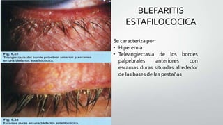 Blefaritis | PPTX