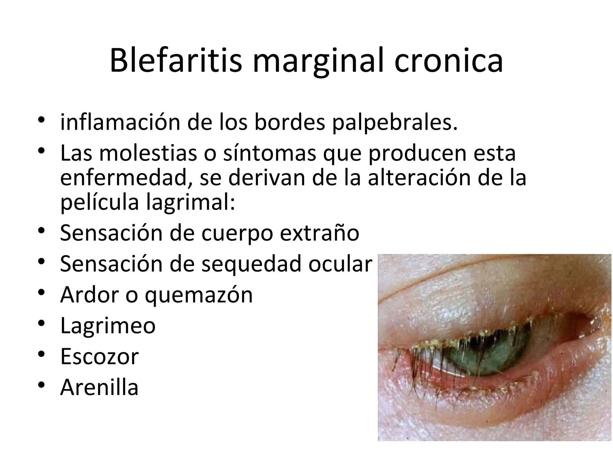 Blefaritis marginal cronica | PPT