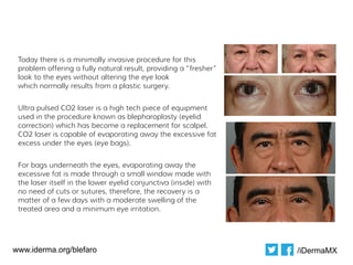 Blefaro: english | PDF