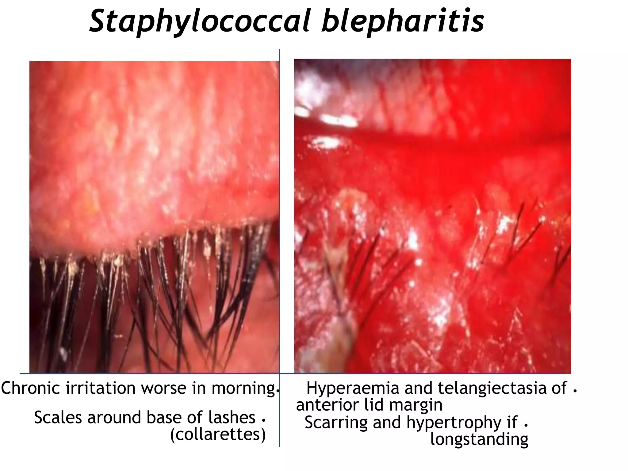 Blepharitis | PPTX