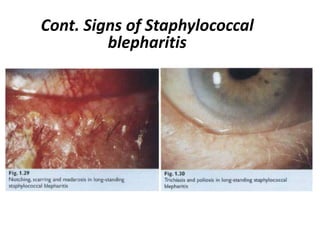 Seborrheic Blepharitis