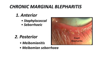 Seborrheic Blepharitis Treatment