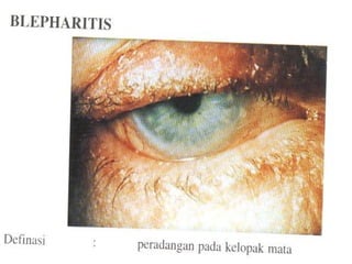 BLEPHARITIS | PPT