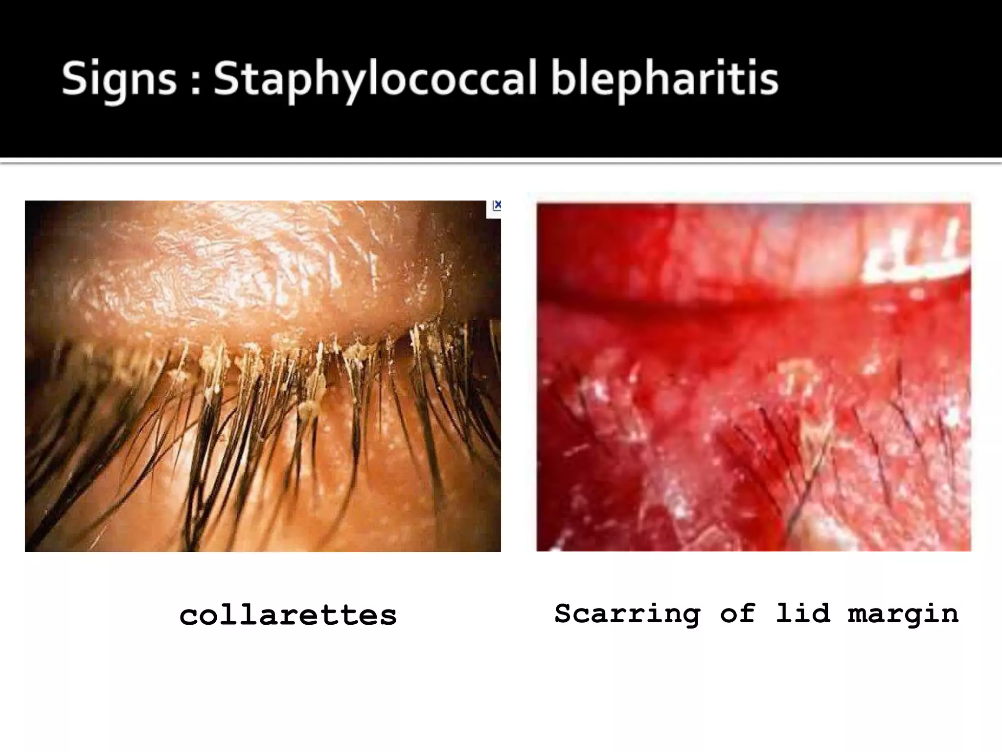 Blepharitis : Overview and management | PPTX
