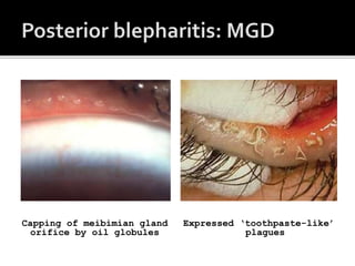 Blepharitis : Overview and management | PPTX
