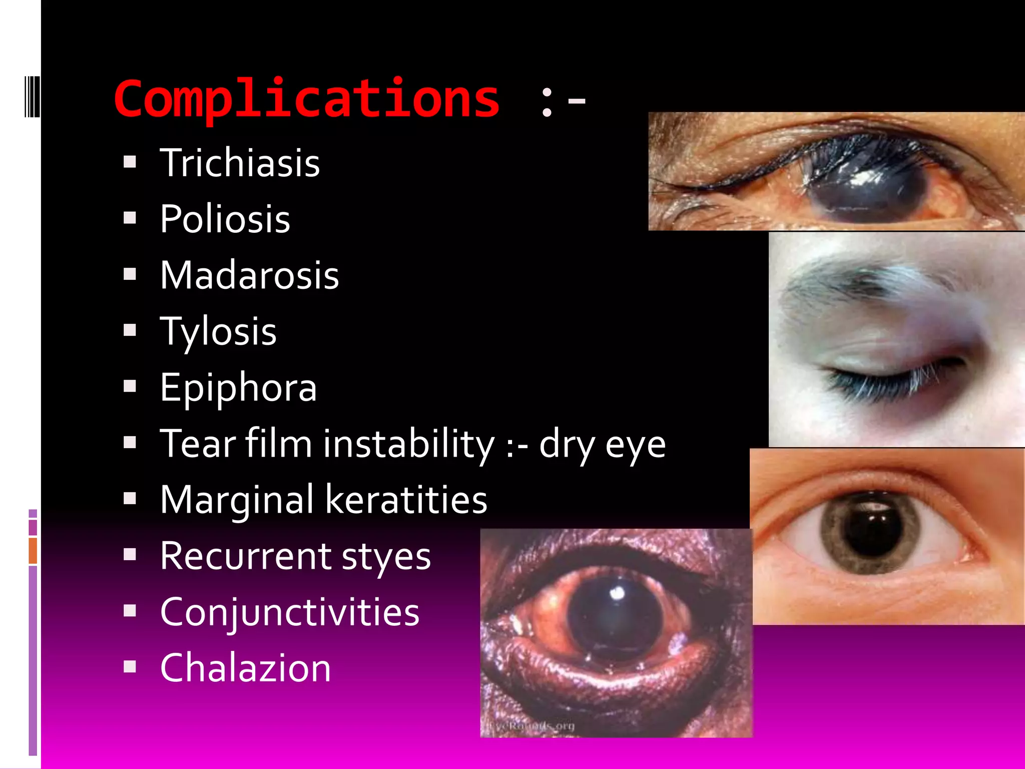 Blepharitis | PPTX