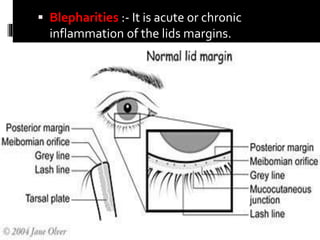Blepharitis | PPTX