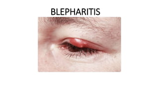 Blepharitis | PPTX