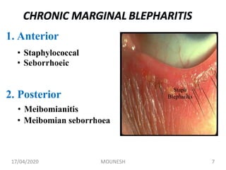 Blepharitis | PPTX