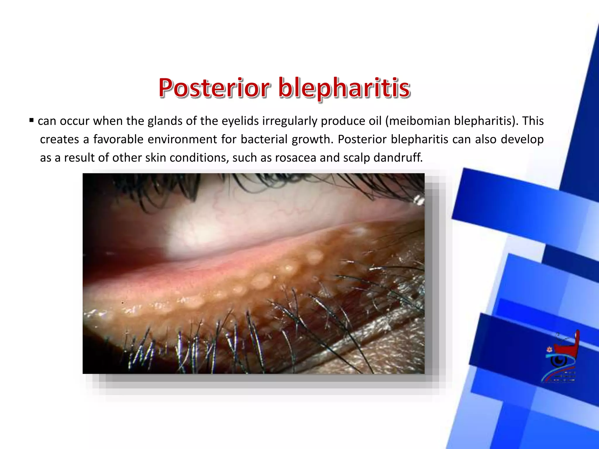 Blepharitis | PPTX
