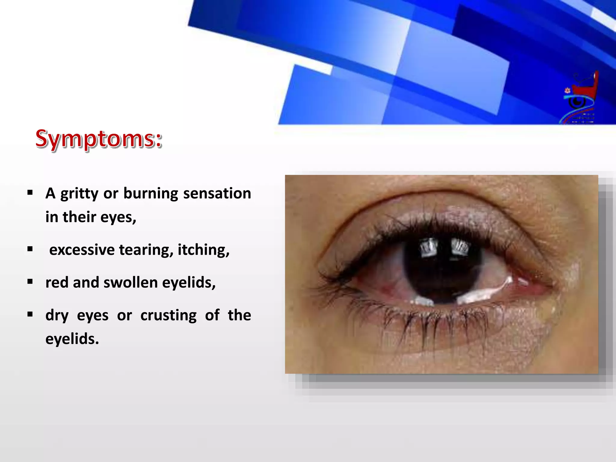 Blepharitis | PPTX