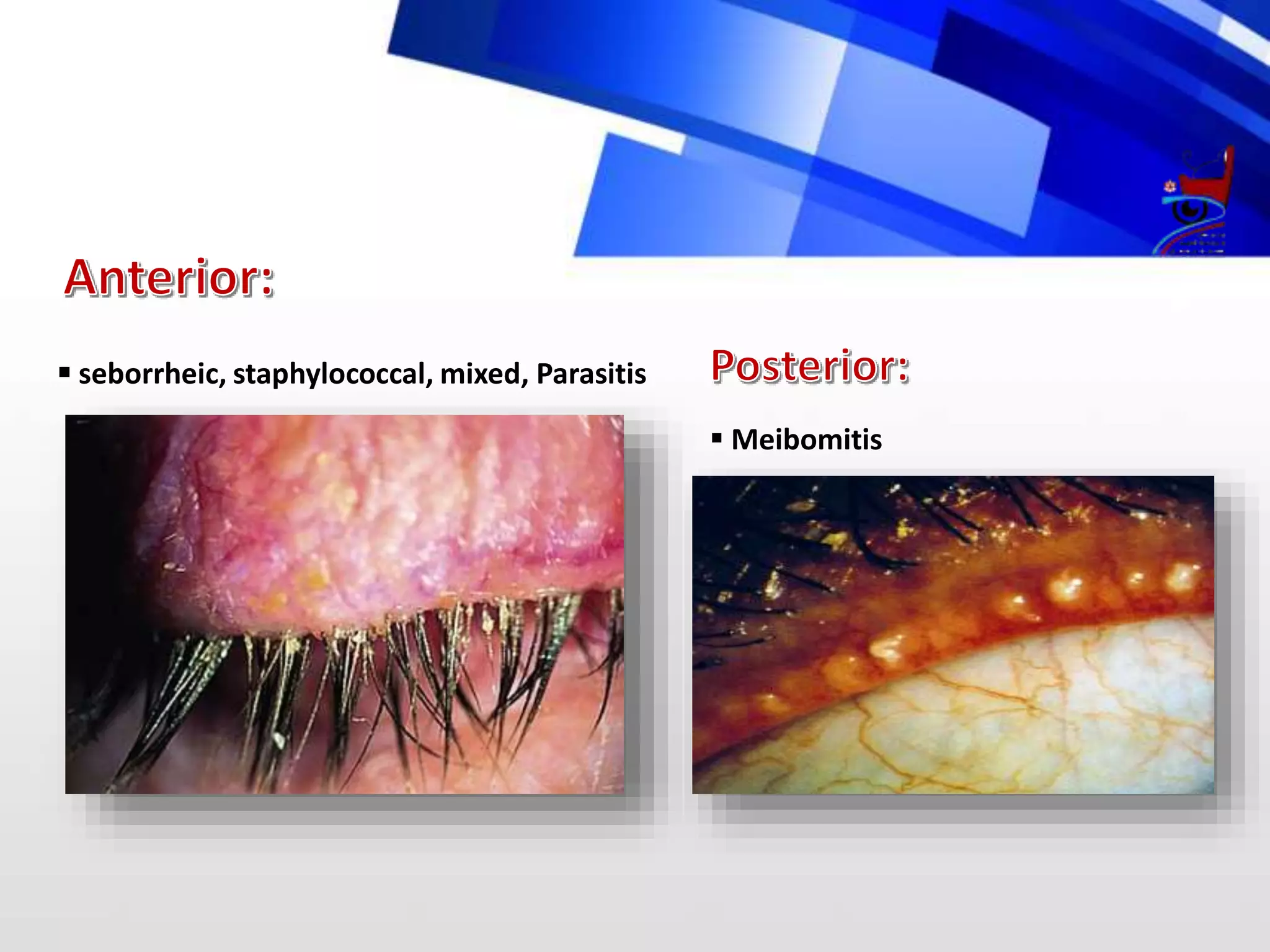 Blepharitis | PPTX | Eye and Vision Conditions | Diseases and Conditions