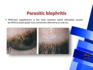 Blepharitis | PPTX