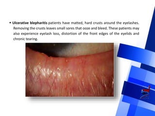 Blepharitis | PPTX