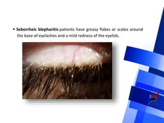 Seborrheic Vs Staph Blepharitis