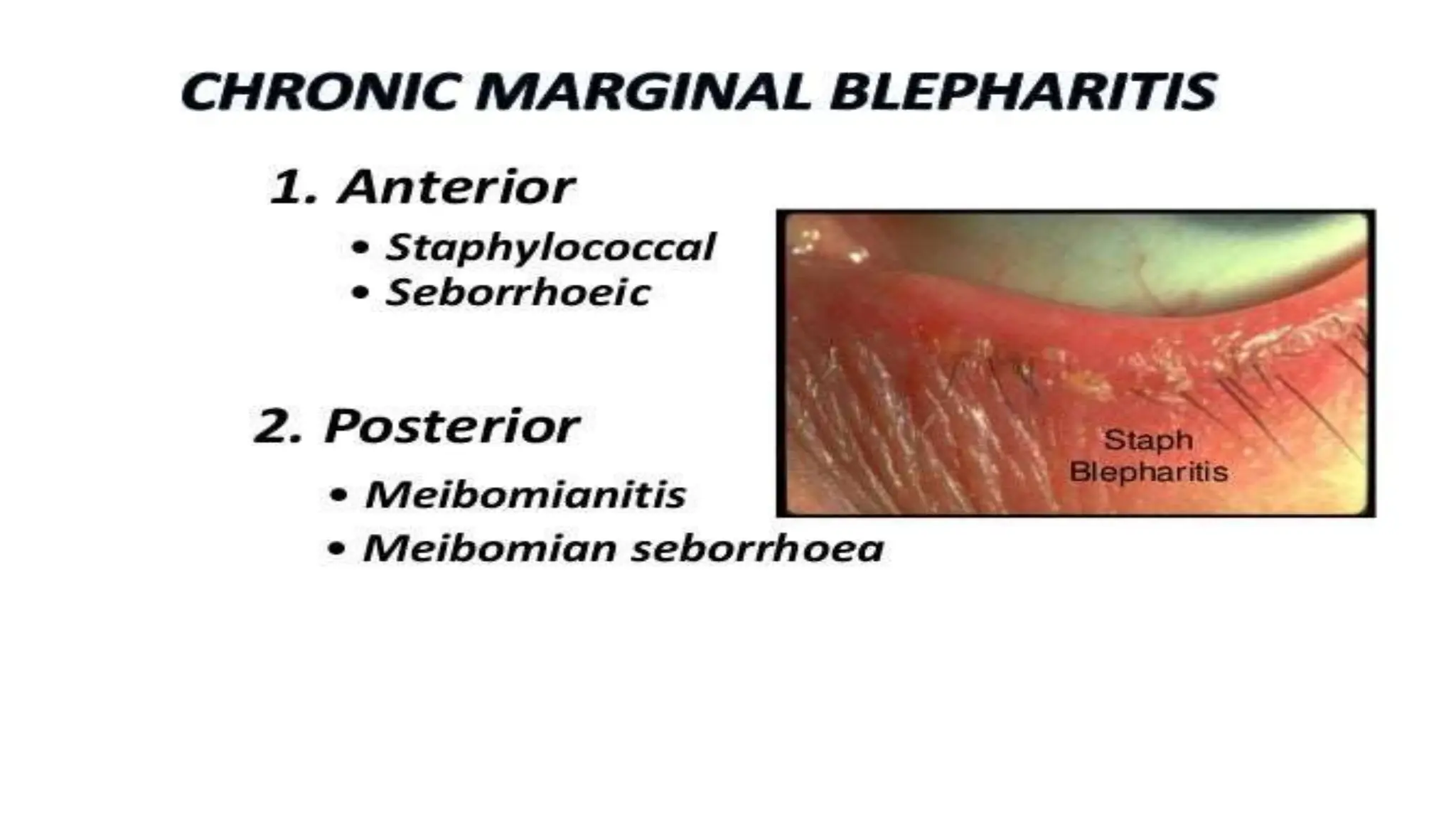 Blepharitis Eye disorder Medical Surgical Nursing-II | PPT