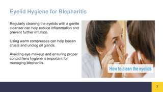 Blepharitis inflammation of eyelid symptoms cause everything included along with the pictures | PPTX