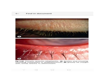 BLEPHARITIS-WPS Office.pptx.ppt