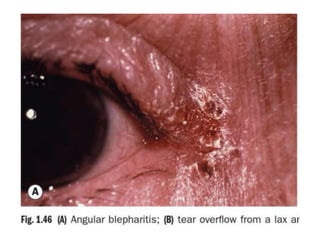Angular Blepharitis