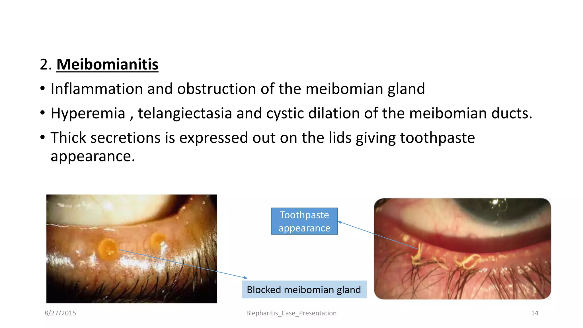 Case report-Blepharitis | PPTX