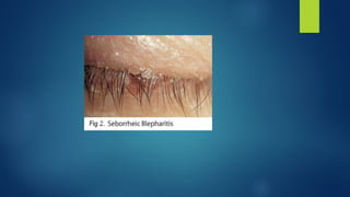 Blepharitis - diagnosis and management . | PPT