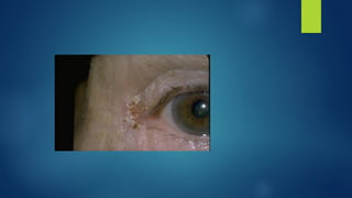 Blepharitis - diagnosis and management . | PPTX | Eye and Vision ...