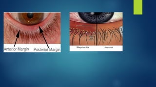 Blepharitis - diagnosis and management . | PPTX